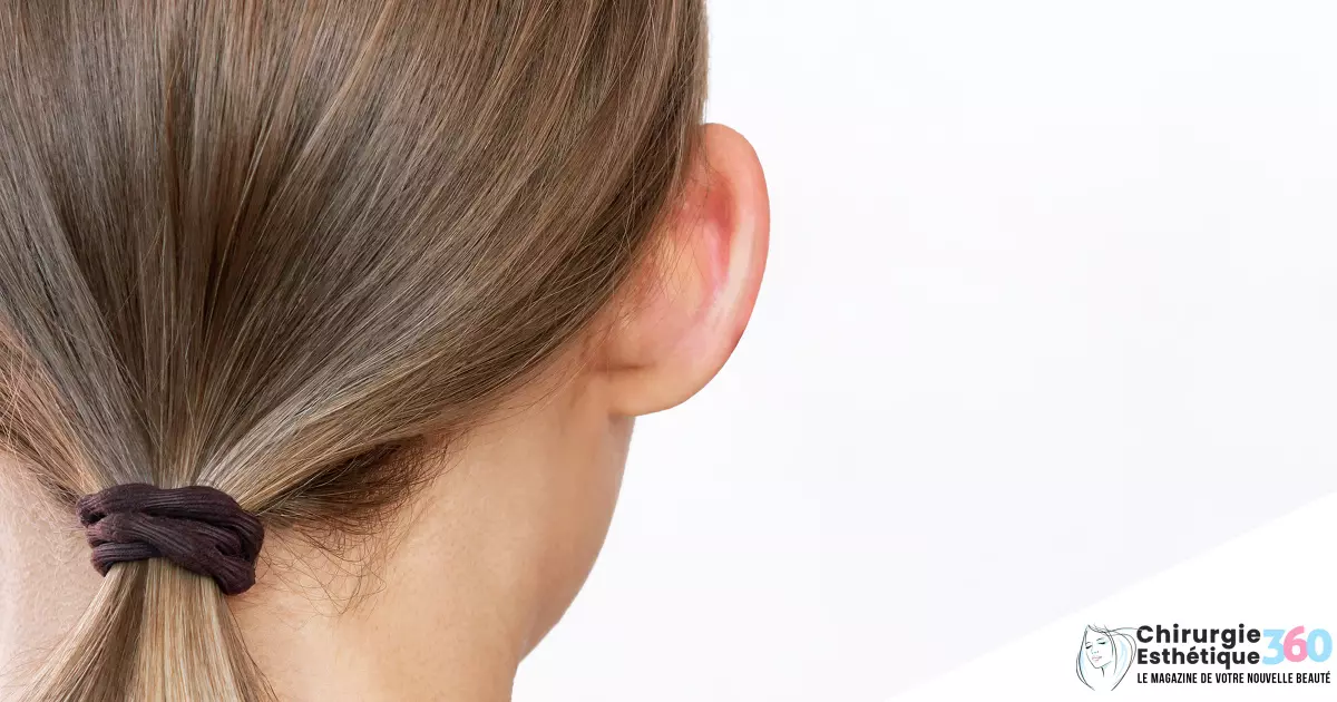 Correction des Oreilles Décollées : Avant et Après Otoplastie [Image ...