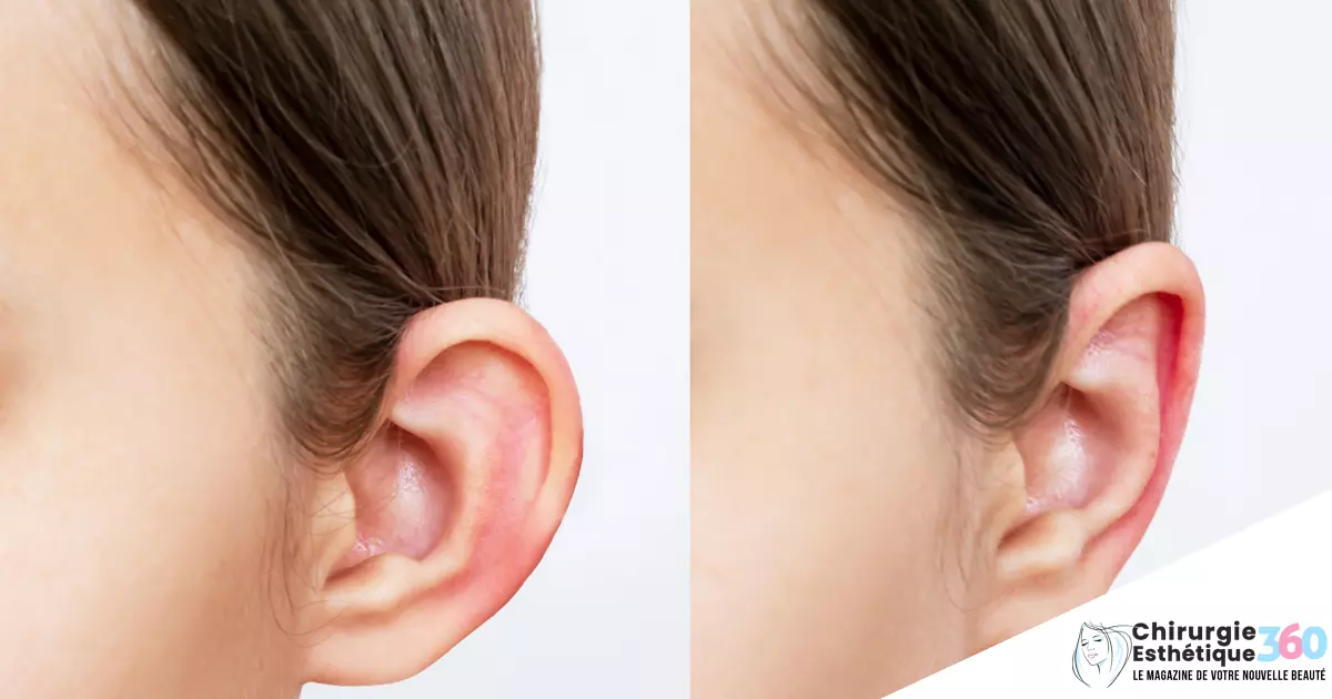 Tout ce que vous devez savoir sur l'otoplastie : une chirurgie ...